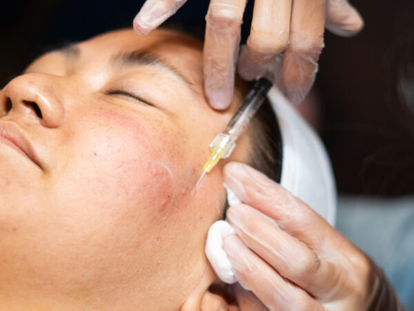 Deep, stubborn acne scars? X-Scar has the answer - Garage